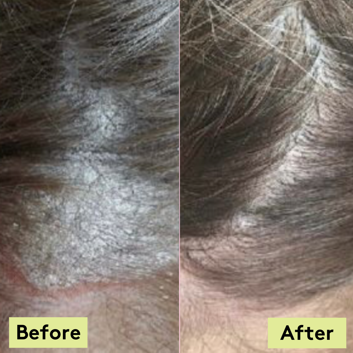 Natural Scalp Treatment For Psoriasis & Eczema-Prone Scalp